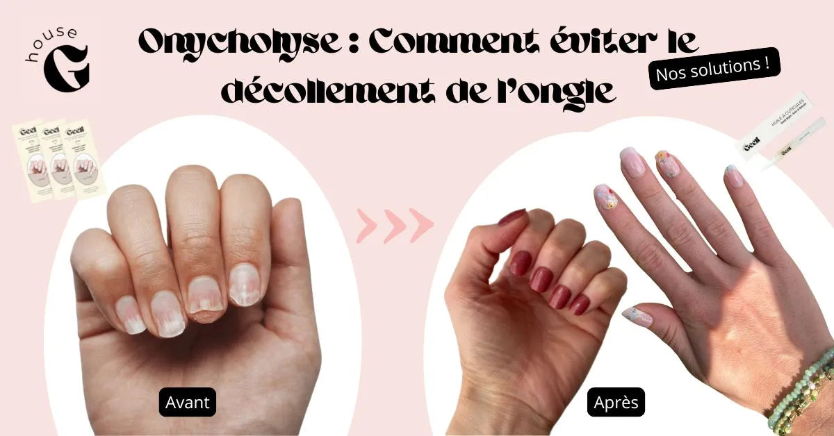 Onycholyse : Comment éviter le décollement de l’ongle | Geeli House